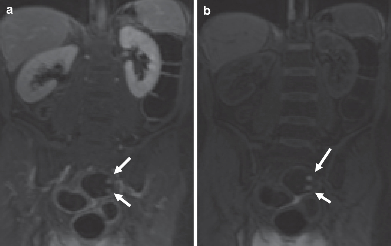 MRI of the Colon (MR Colonography): Technique | SpringerLink