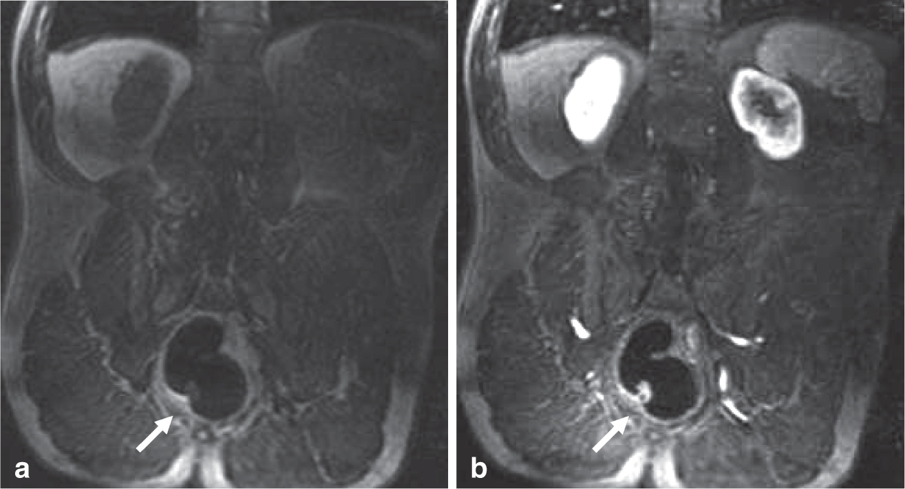 MRI of the Colon (MR Colonography): Technique | SpringerLink