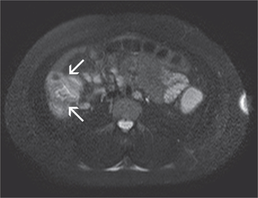 MRI of the Colon (MR Colonography): Technique | SpringerLink