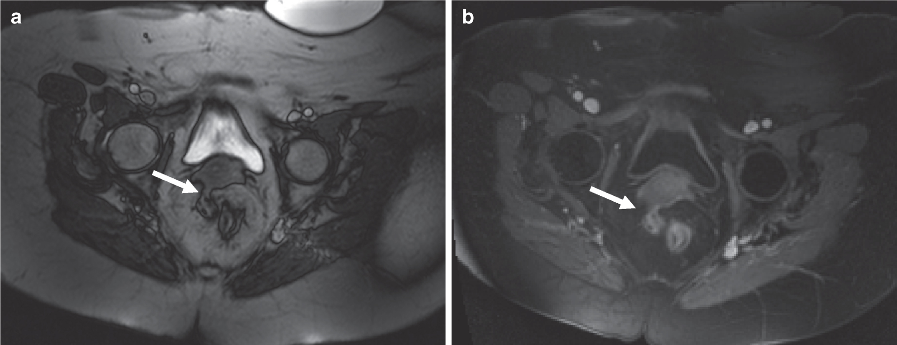 MRI of the Colon (MR Colonography): Technique | SpringerLink