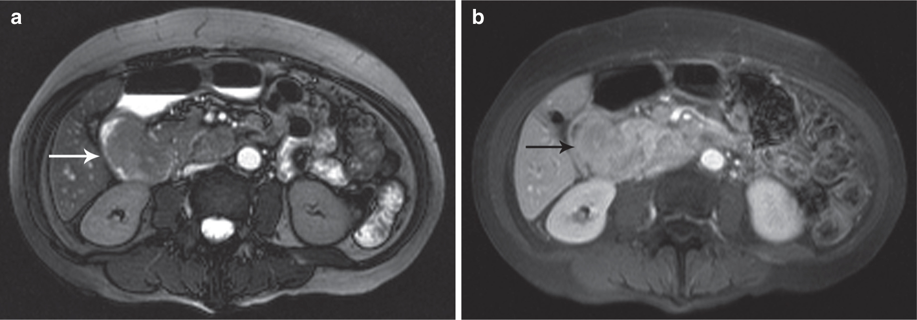 MRI of the Duodenum | SpringerLink