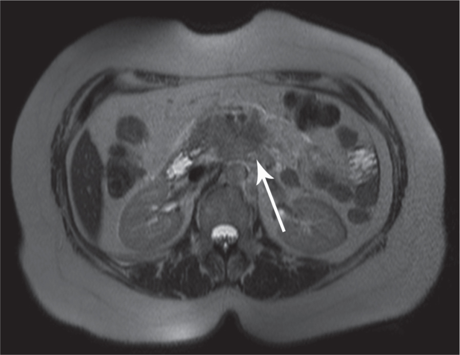 MRI of the Duodenum | SpringerLink