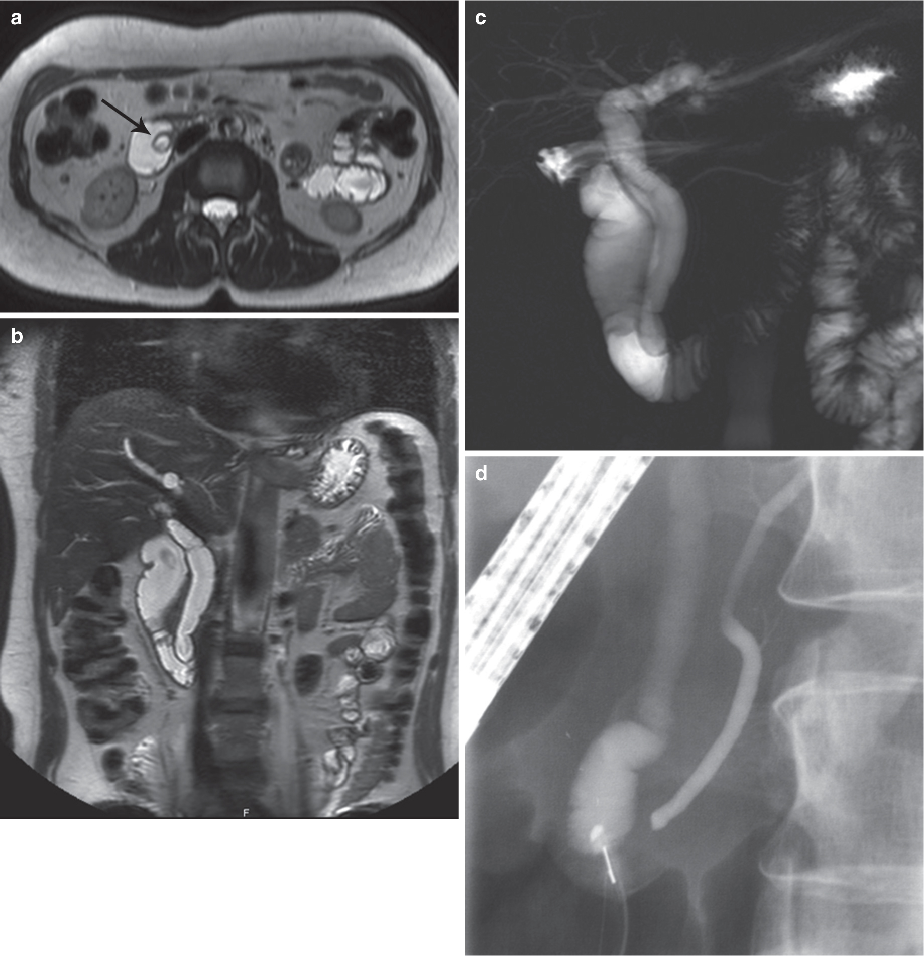 MRI of the Duodenum | SpringerLink