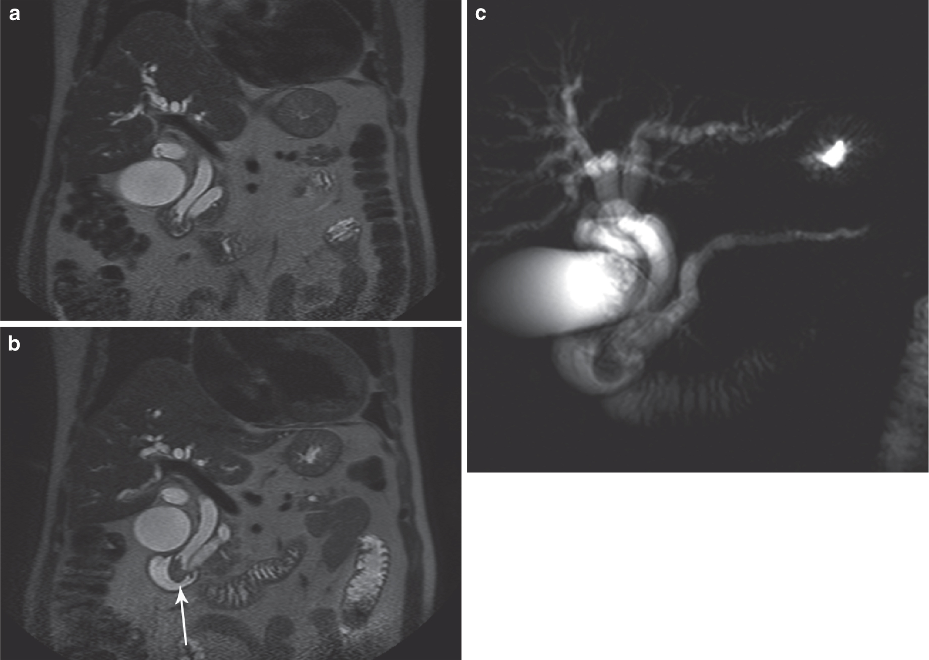 MRI of the Duodenum | SpringerLink
