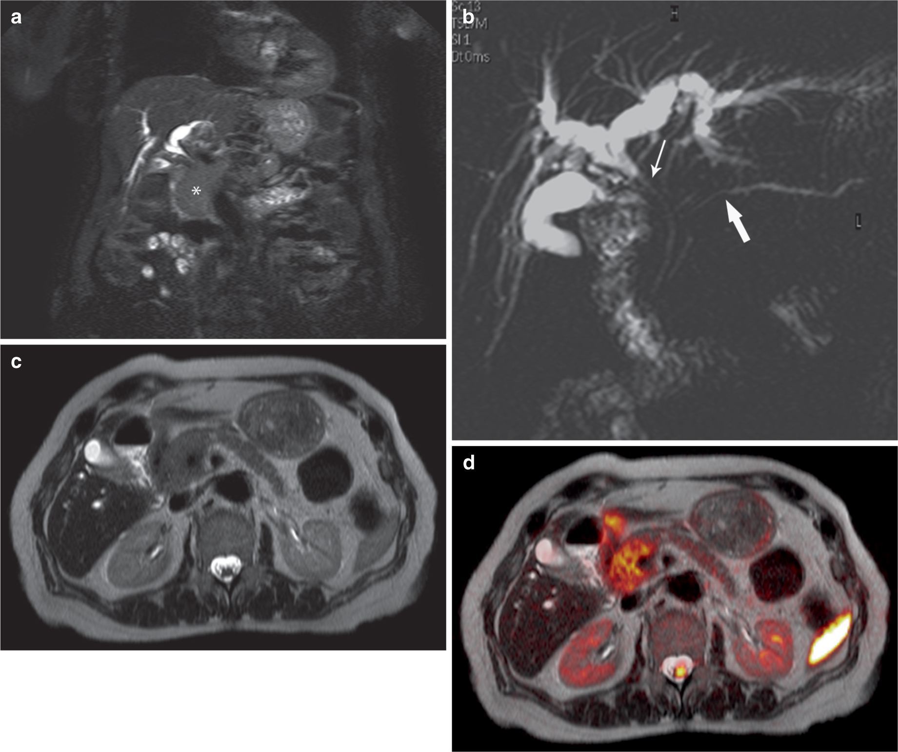 MRI of the Duodenum | SpringerLink