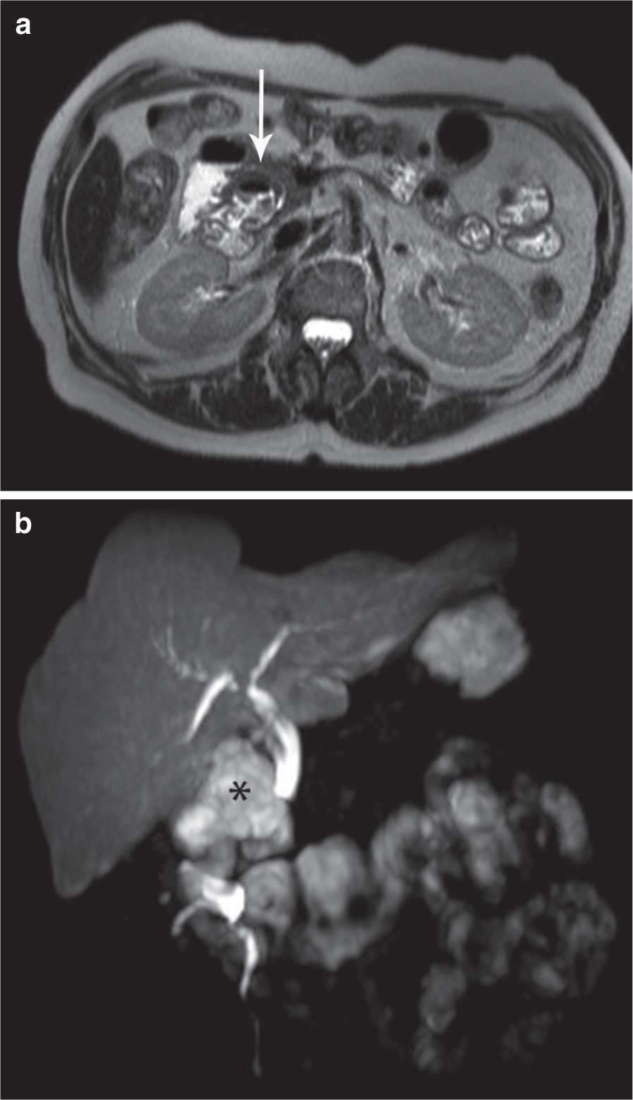MRI of the Duodenum | SpringerLink