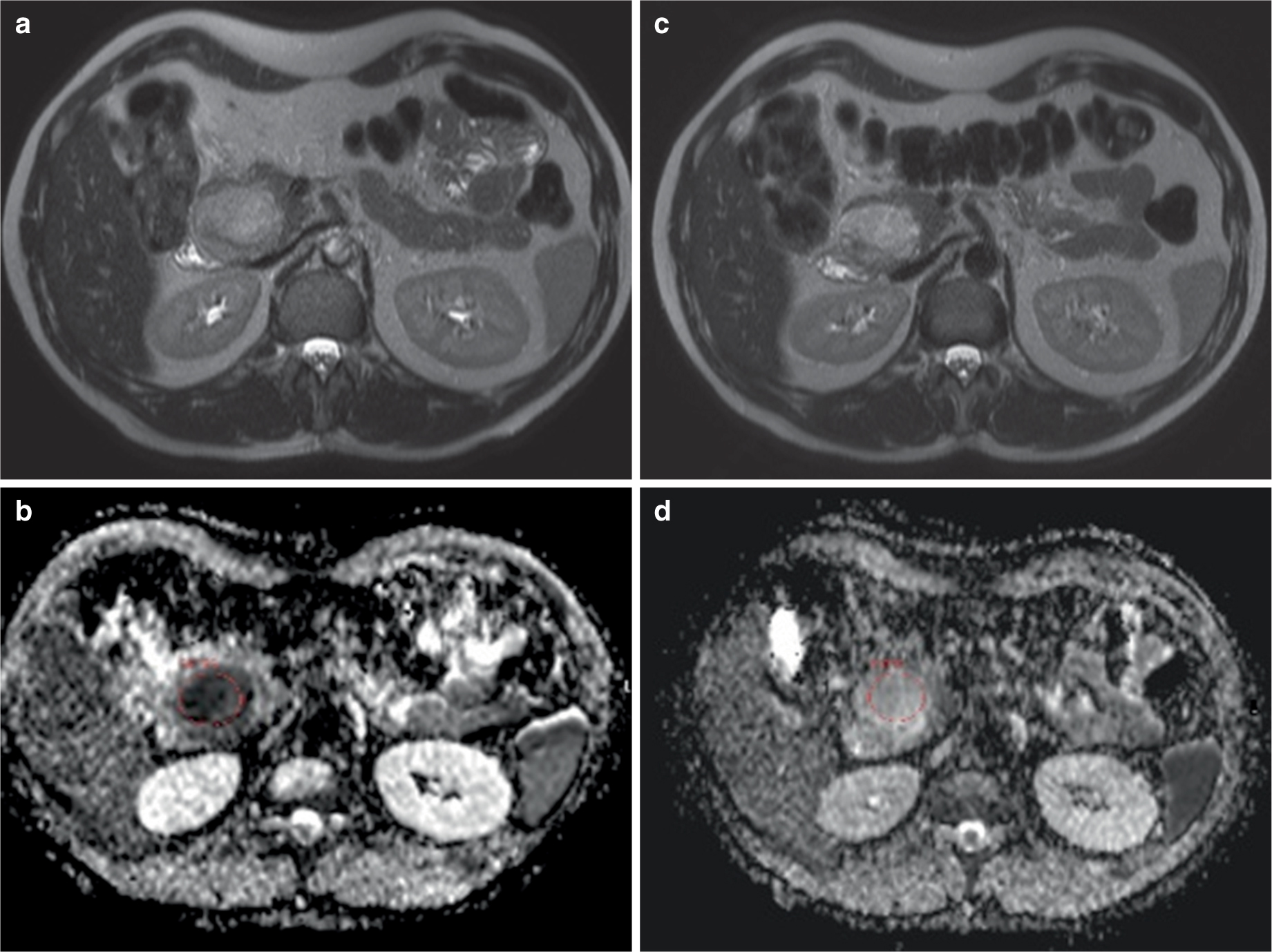 MRI of the Duodenum | SpringerLink
