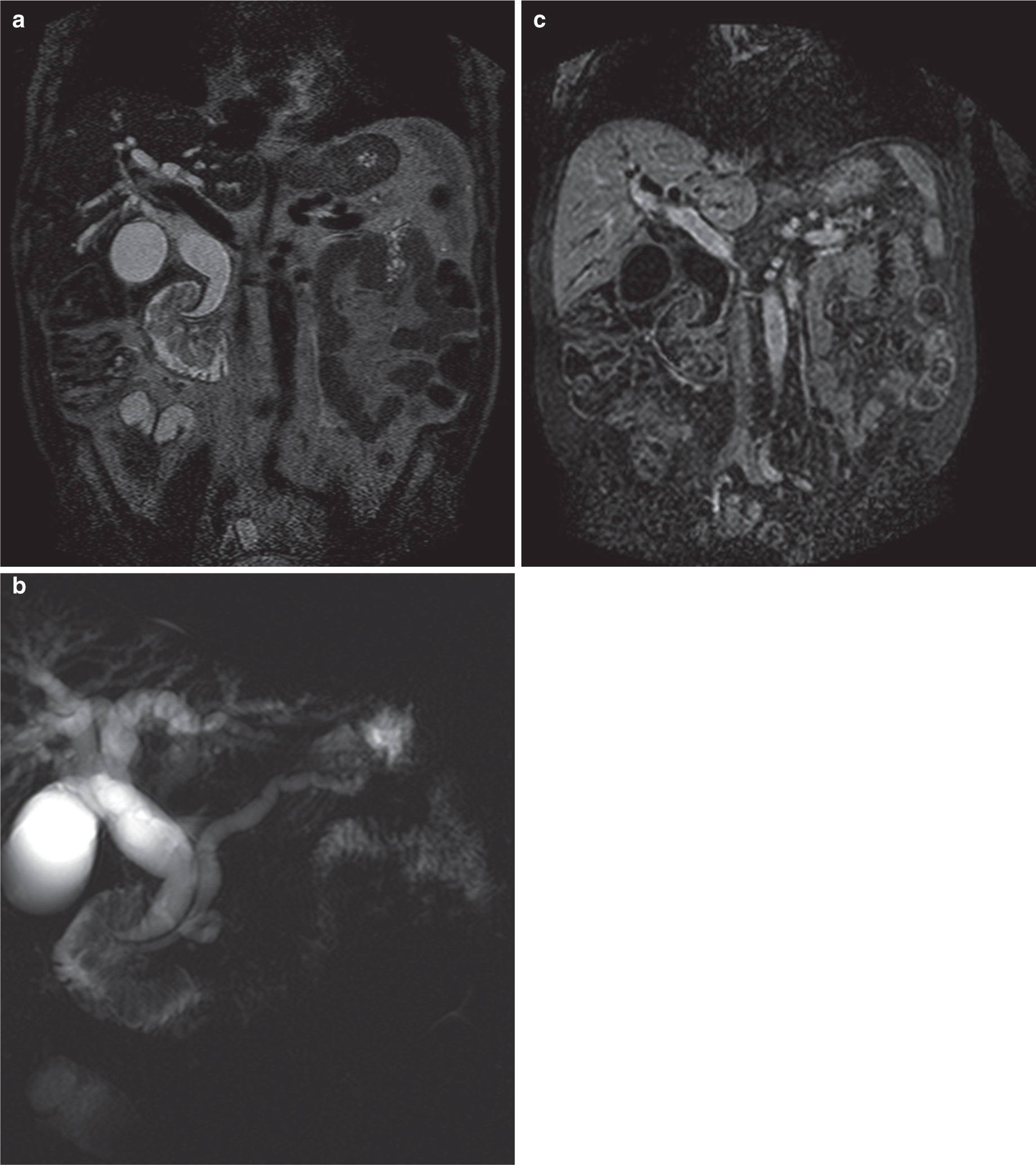 MRI of the Duodenum | SpringerLink