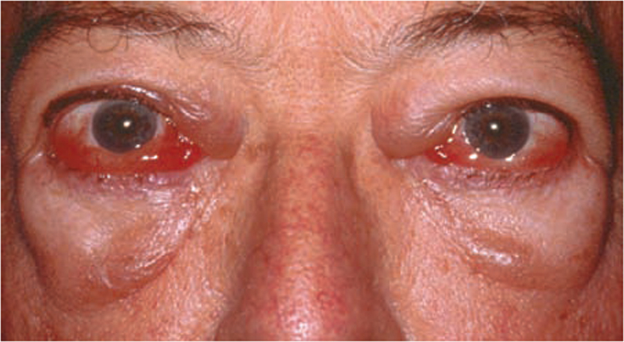 Current Concepts in the Management of Idiopathic Orbital Inflammation ...