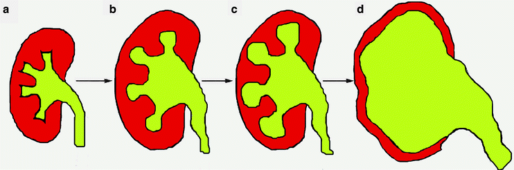 Obstructive Uropathy, Pyonephrosis, and Reflux Nephropathy in Adults ...