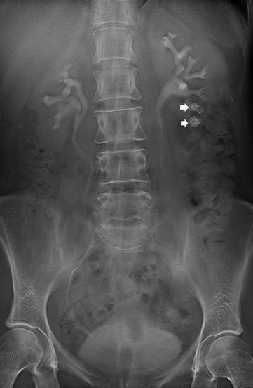 Nephrocalcinosis and Nephrolithiasis | SpringerLink