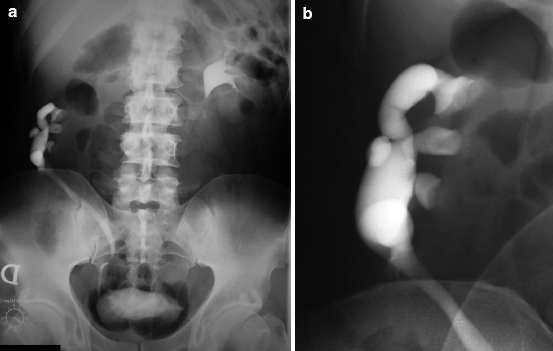 Normal Radiological Anatomy and Anatomical Variants of the Kidney ...