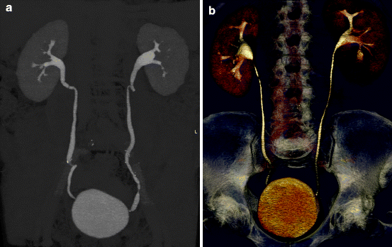 Normal Radiological Anatomy and Anatomical Variants of the Kidney ...