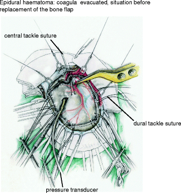 Traumatic Brain Injury | SpringerLink