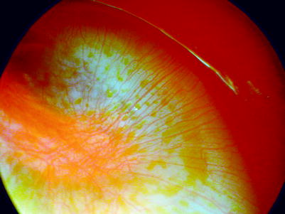 Otitis Media with Effusion | SpringerLink