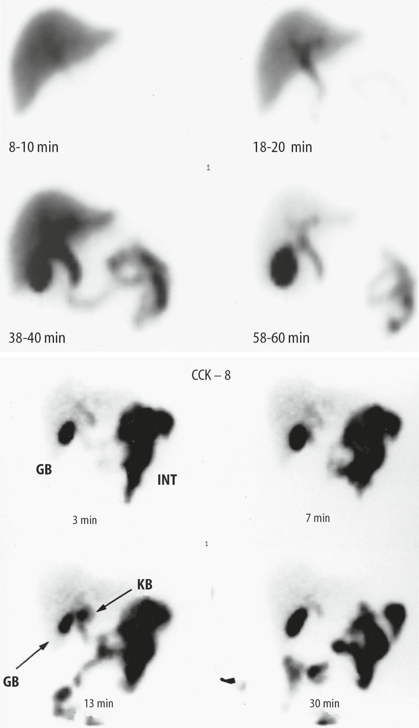 Biliary Dyskinesia | SpringerLink