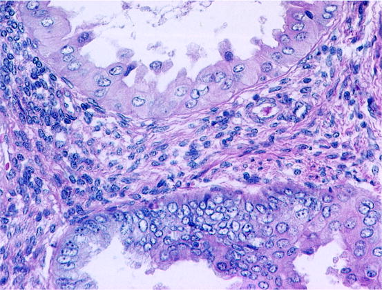 Metaplastic Changes | SpringerLink
