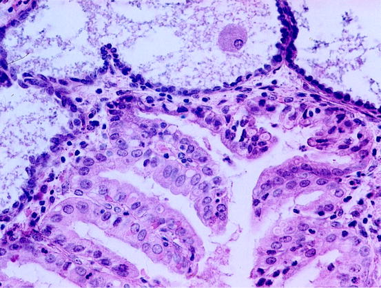 Metaplastic Changes | SpringerLink