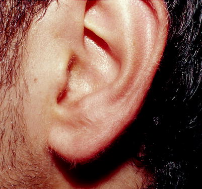 Hypertrichosis | SpringerLink