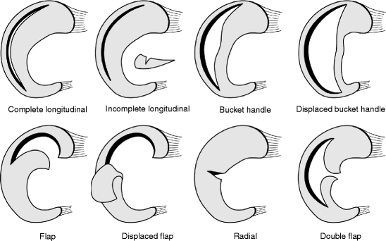 Classification: Discoid Meniscus, Traumatic Lesions | SpringerLink