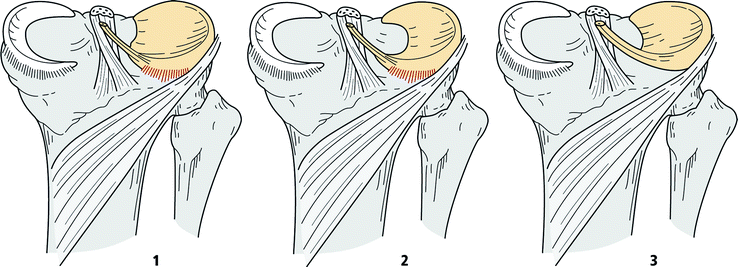 Classification: Discoid Meniscus, Traumatic Lesions | SpringerLink