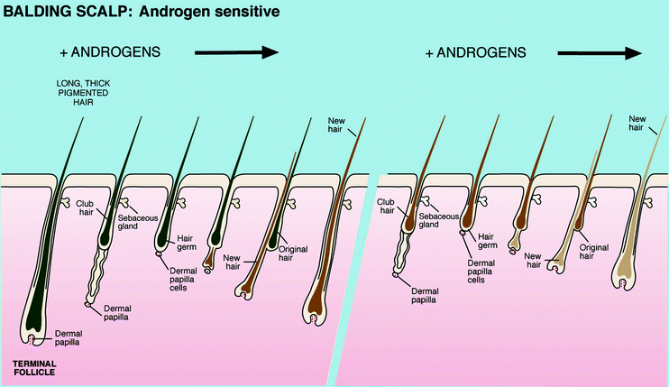 Molecular Basis of Androgenetic Alopecia | SpringerLink