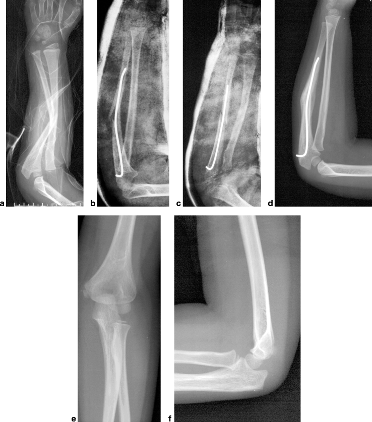 Both-Bone Forearm Fracture | SpringerLink