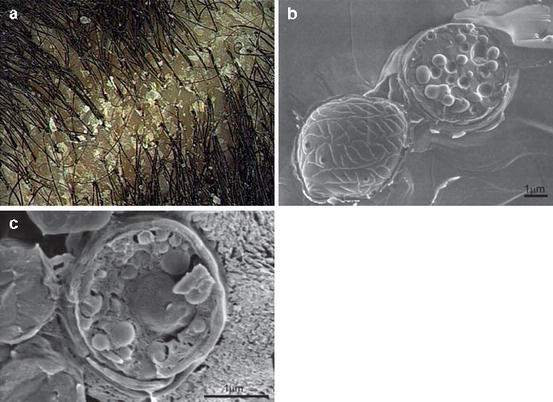 Genomics and Pathophysiology: Dandruff as a Paradigm | SpringerLink
