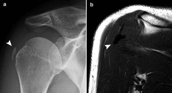 CPPD and HADD | SpringerLink