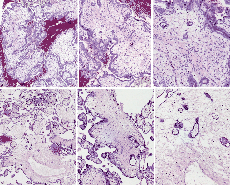 Gestationsbedingte Trophoblasttumoren | SpringerLink