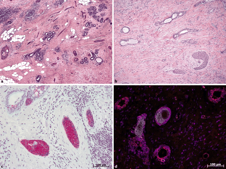 Invasive Karzinome | SpringerLink