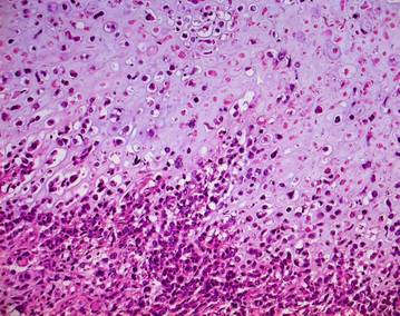 Invasive Karzinome | SpringerLink