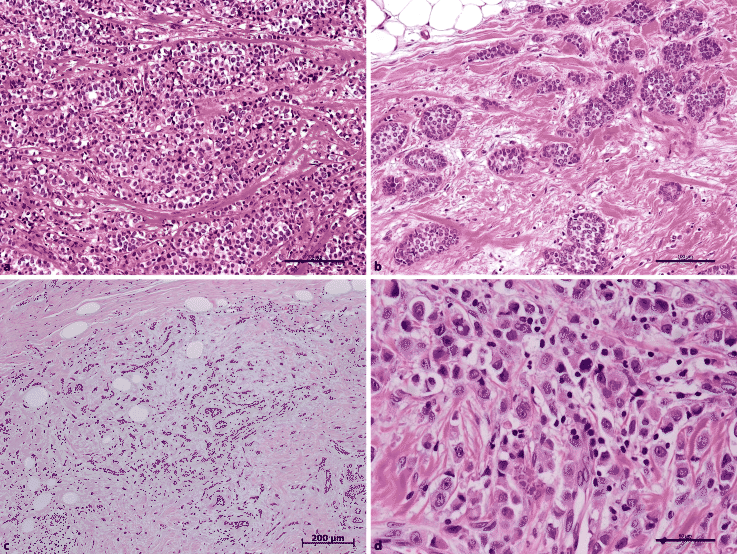 Invasive Karzinome | SpringerLink