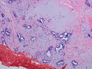 Invasive Karzinome | SpringerLink