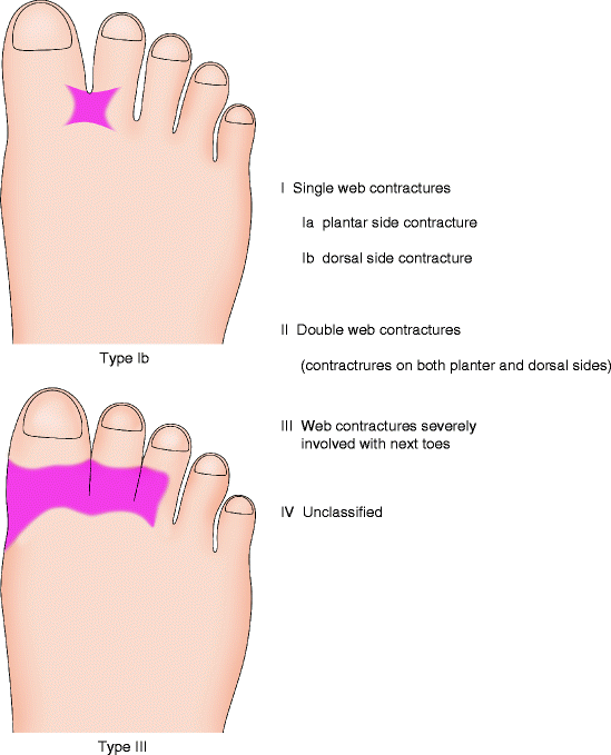 Diagnosis, Assessment, and Classification of Scar Contractures ...
