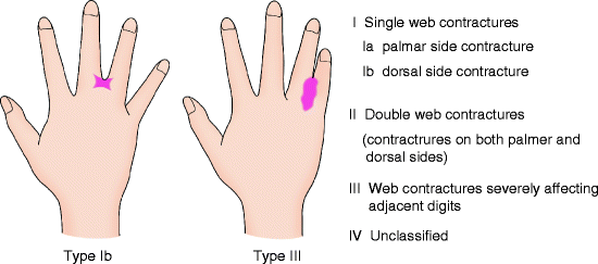 Diagnosis, Assessment, and Classification of Scar Contractures ...