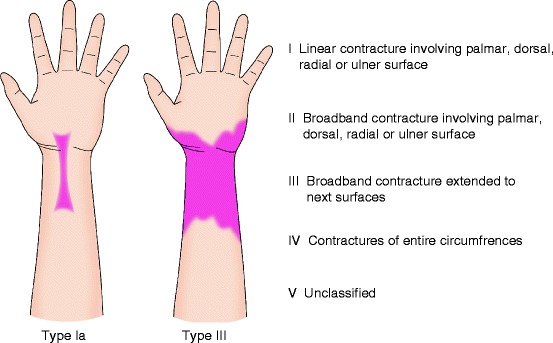 Diagnosis, Assessment, and Classification of Scar Contractures ...