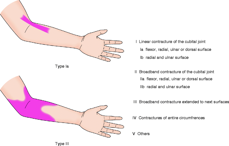 Diagnosis, Assessment, and Classification of Scar Contractures ...