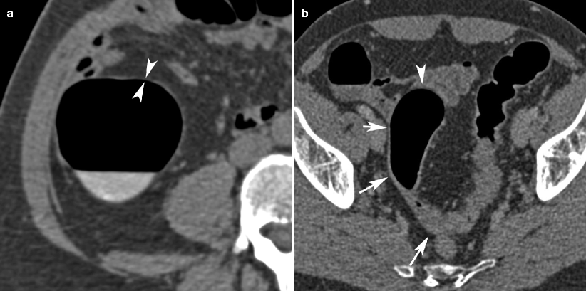 Normal Colon | SpringerLink