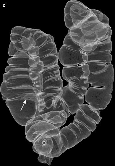 The Ileocecal Valve | SpringerLink
