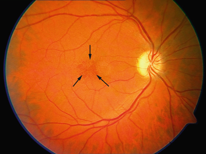 Netzhaut | SpringerLink