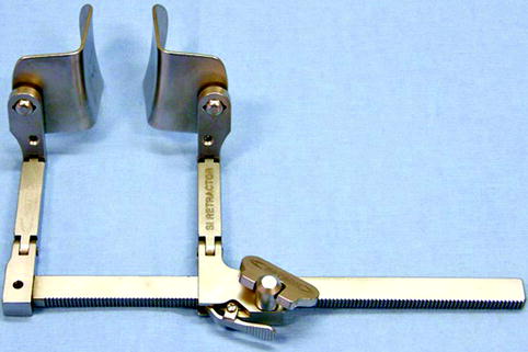 Minimally Invasive Mitral Valve Surgery via Right Minithoracotomy ...