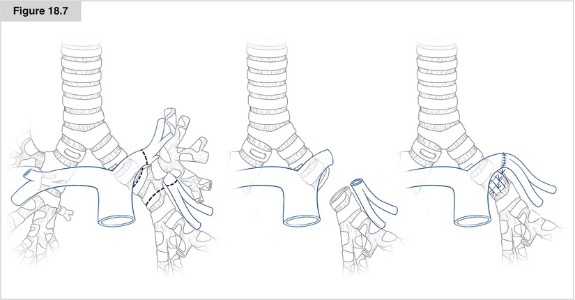 Bronchial Sleeve Resection | SpringerLink