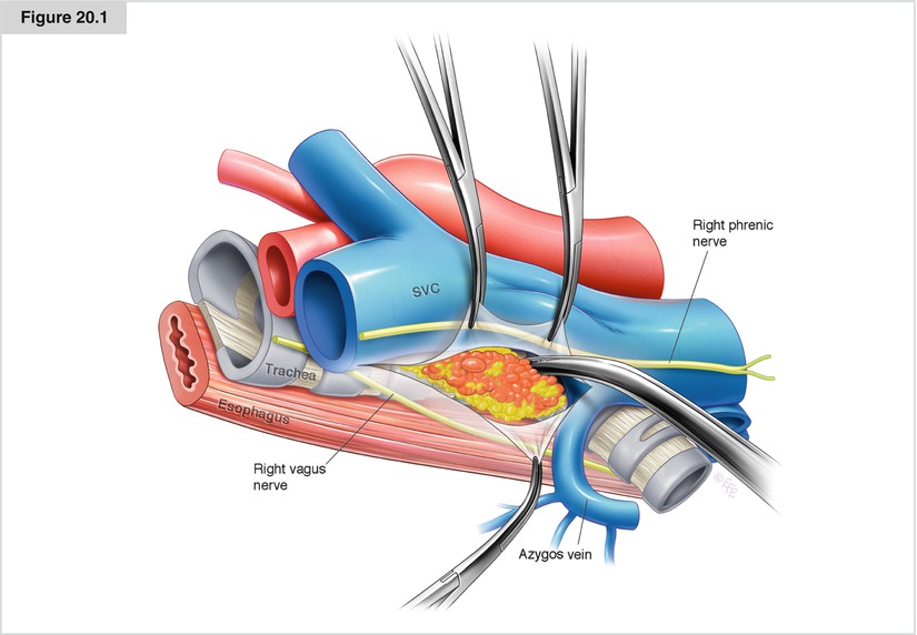 Lymph Node Dissection | SpringerLink
