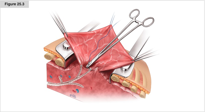 Bullectomy | SpringerLink