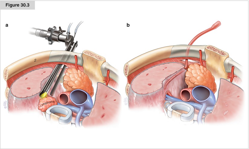 Mediastinotomy | SpringerLink