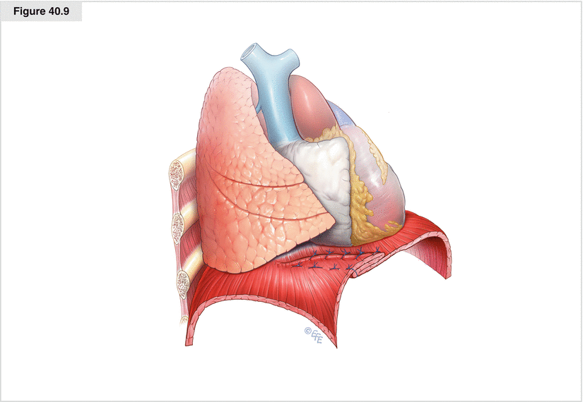 Pleurectomy and Decortication for Mesothelioma | SpringerLink