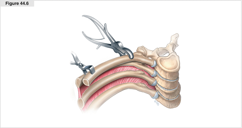 Thoracoplasty | SpringerLink