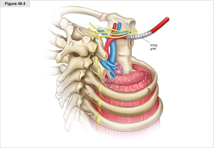 Superior Pulmonary Sulcus (Pancoast) Tumors | SpringerLink