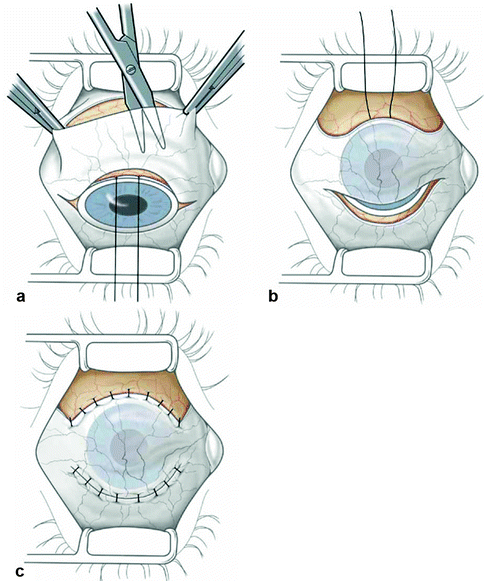 Ocular Surface and Reconstructive Surgery | SpringerLink